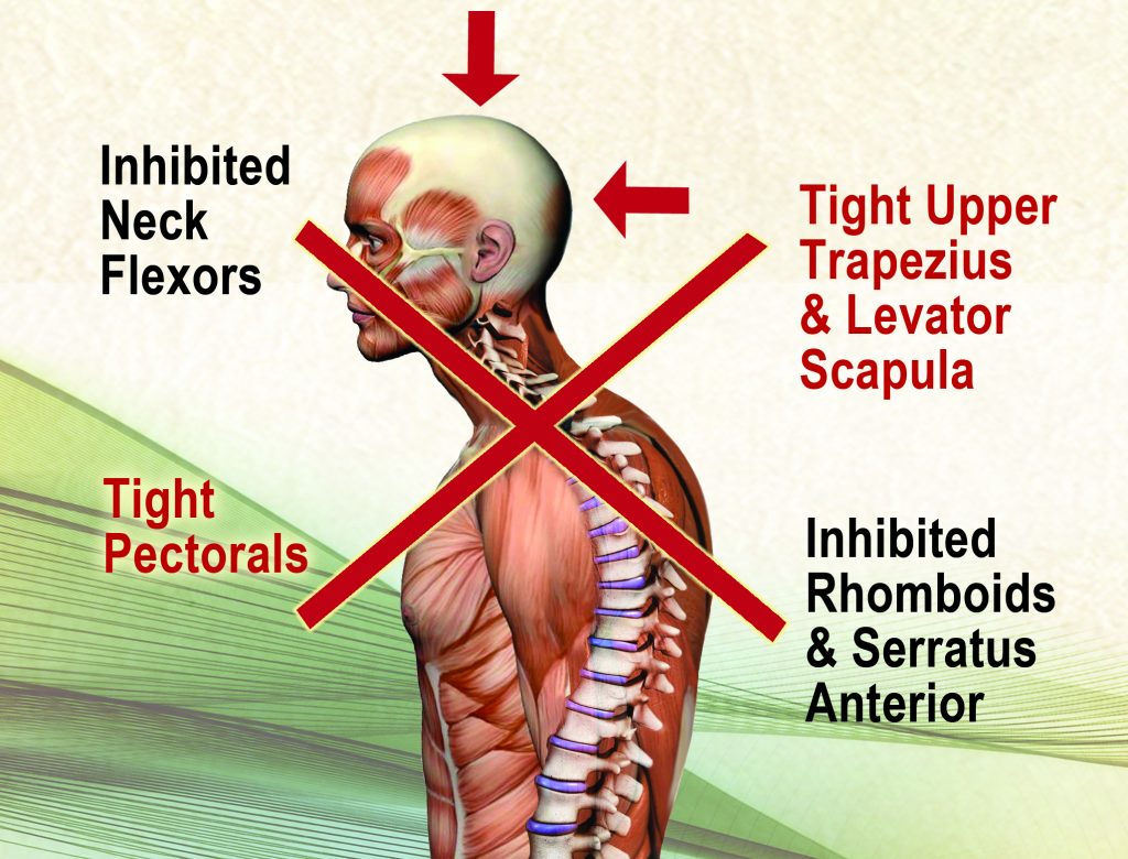 Upper Cross Controversy: Addressing Postural Plasticity