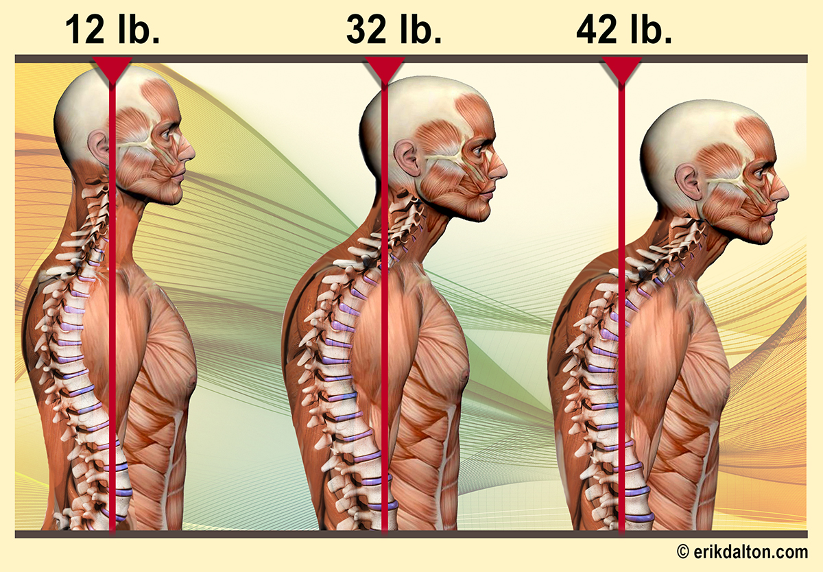 Upper Cross Controversy: Addressing Postural Plasticity